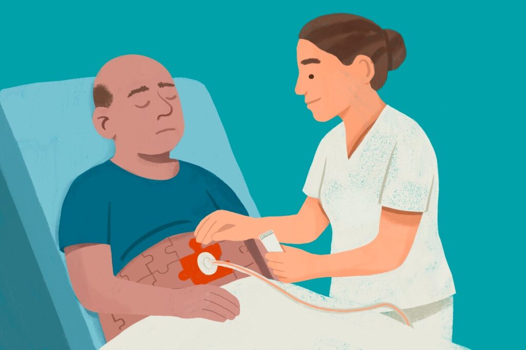 Percutane voedingssondes: complicaties en verzorging | Nursing.nl